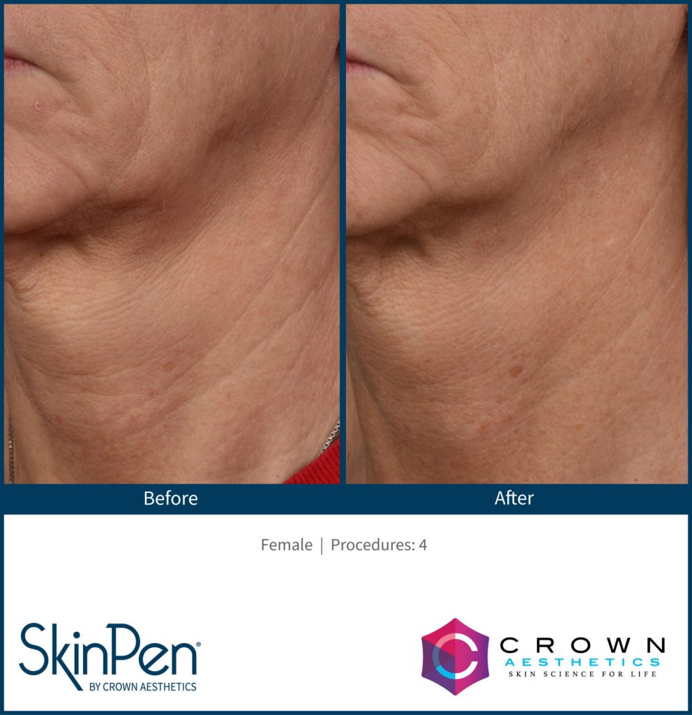 SkinPen Microneedling SkinPen Microneedling